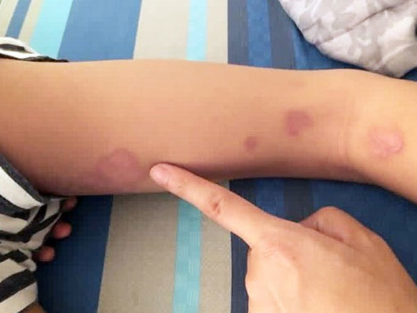 Nữ sinh ở Đắk Lắk được phát hiện mắc bệnh Whitmore - ThienNhien.Net ...